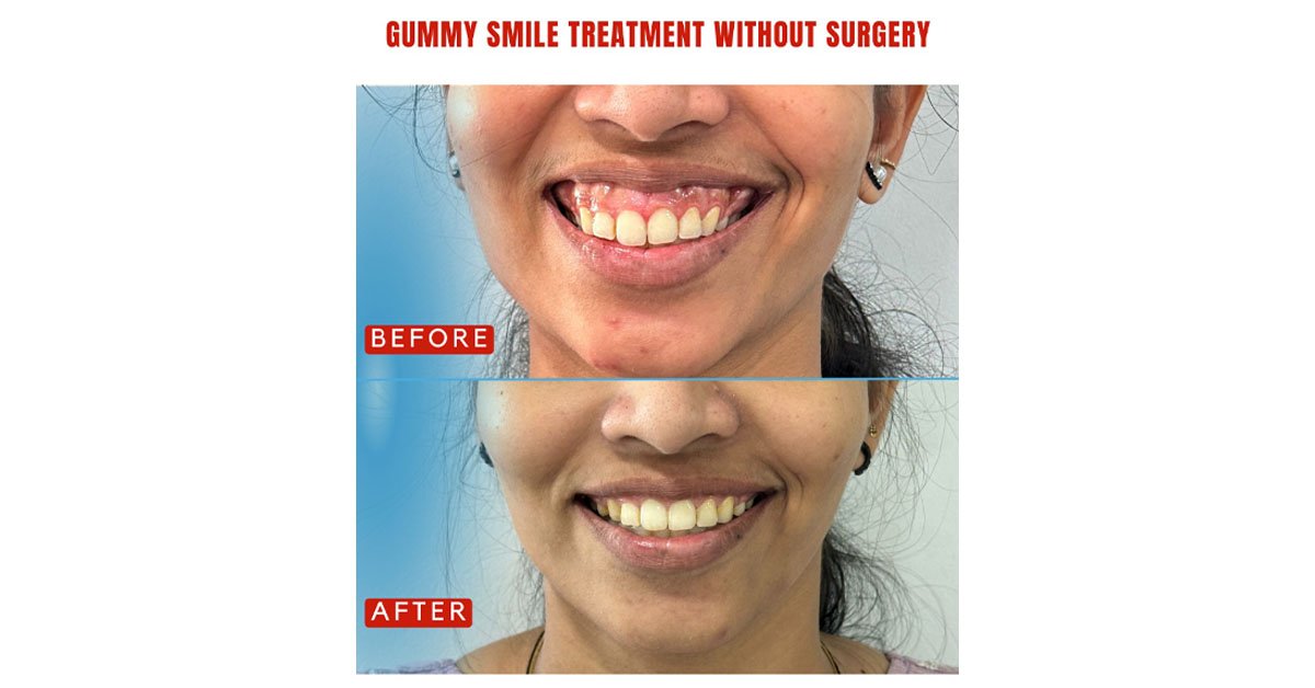 Why Non-Surgical Gummy Smile Treatments Are the Top Choice? - Blog